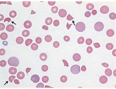 Picture Showing Polychromasia And Schistocytes Rbcs Fragmentsprickle