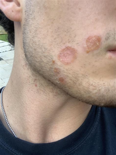Staph Infection Scar Pictures At Shirley Vining Blog