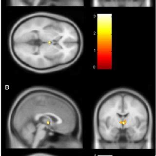 Sex Differences In Hypothalamus Activation A Hypothalamus Activation Download Scientific