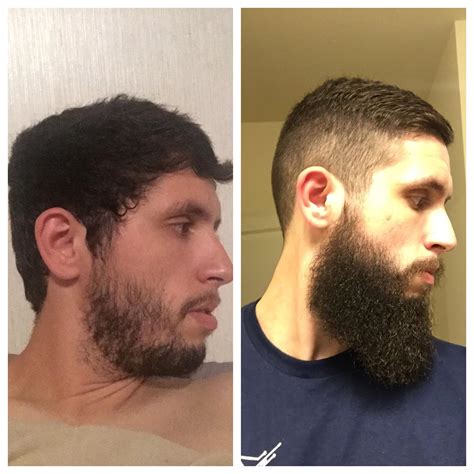 Patchy Beards Before And After Dailybonniecombs