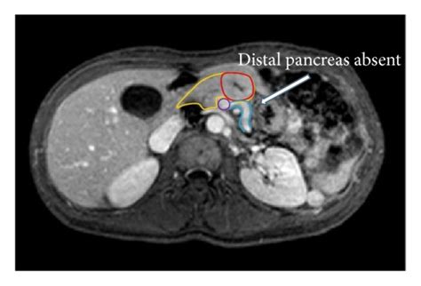 Axial Image Of An Mrcp Demonstrating The Relevant Anatomy Of The Tumor Download Scientific