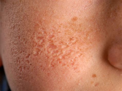 Ulerythematosa Reticulata Folliculitis Atrophoderma Vermiculata A