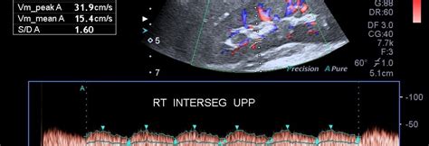 Aortoarteritis With Bl Ras Case By Dr Nitin Jadhav