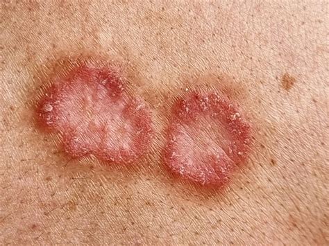 Células Escamosas Qué Significa Y Cuándo Preocuparse