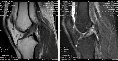 Mri Knee Acl Tear