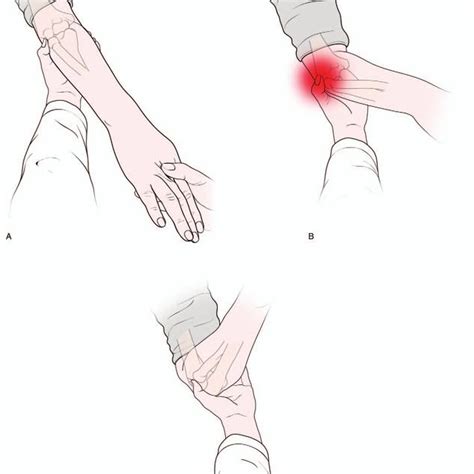 Pdf Clinical And Diagnostic Outcomes In Arthroscopic Treatment For Posterolateral Plicae