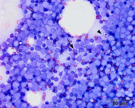 Mediastinal Mass Archives Eclinpath