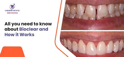 What Is Bioclear And How It Works