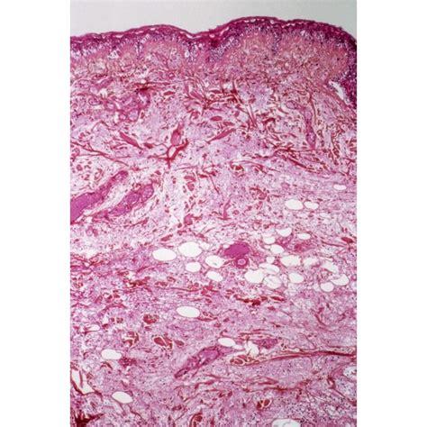 Technique Eases Analysis Damaged Rna