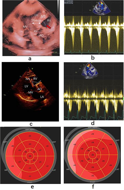 Frontiers Sigmoid Ventricular Septum Treated With Endocardial