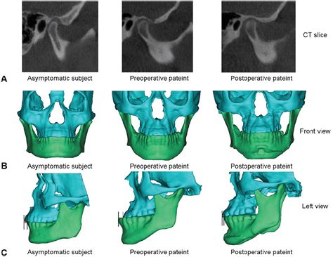 Mandibular Prognathism Radiology
