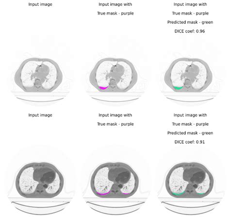 Github Ltvnsergeypleural Effusion Detection Detect Pleural Effusion Using Neural Network
