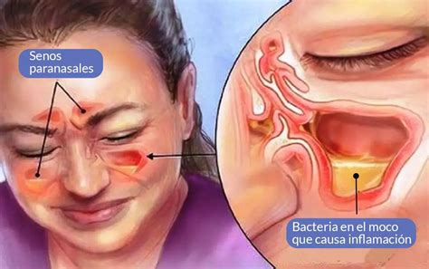 Cómo Quitar El Dolor De Cabeza Por Sinusitis Doctor Online