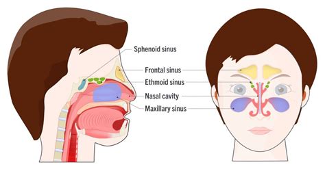 Allergic Sinusitis Allergy And Asthma Consultants Llp Dba Charleston