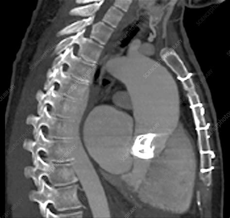 Ascending Thoracic Aortic Aneurysm Ct Scan Stock Image C052 7569 Science Photo Library