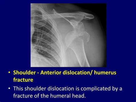 Dislocations Of Joint Joint Dislocation Pptx Death Injury Or