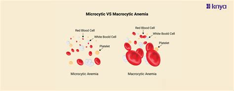 Difference Between Microcytic And Macrocytic Anemias Explained Knya
