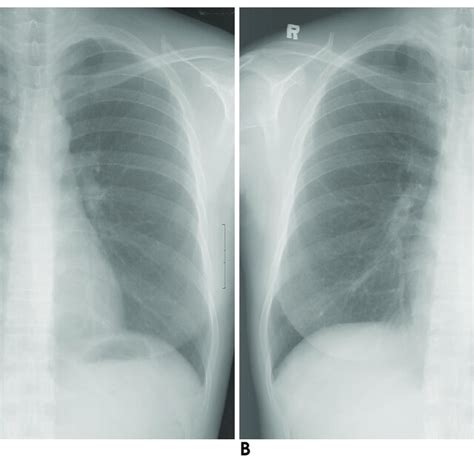 A 35 Year Old Woman With A Normal Chest Radiograph A Download