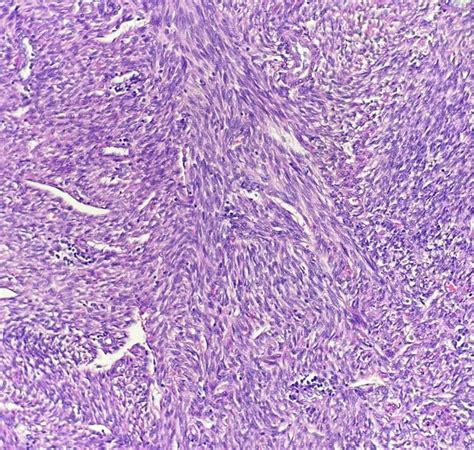 Traditional Serrated Adenoma Rpathology