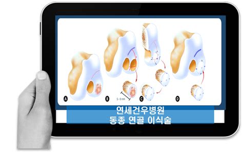 무릎중점병원의 연골연화증 비수술 재활부터 줄기세포 재생치료 까지 네이버 블로그