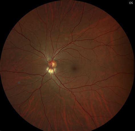 Myelinated Retinal Nerve Fiber Layer Retinara