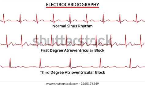 Set Ecg Common Abnormalities Normal Sinus Stock Vector Royalty Free