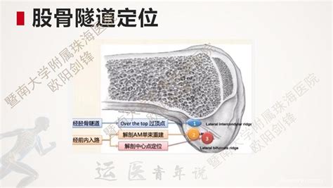 临床技术 四字位辅助内侧入路前交叉韧带单束重建技术 学术园地
