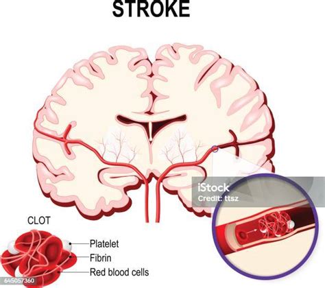 대뇌 동맥에 혈전 허 혈 성 뇌졸중 뇌졸중에 대한 스톡 벡터 아트 및 기타 이미지 뇌졸중 혈액응고 국소성빈혈 Istock