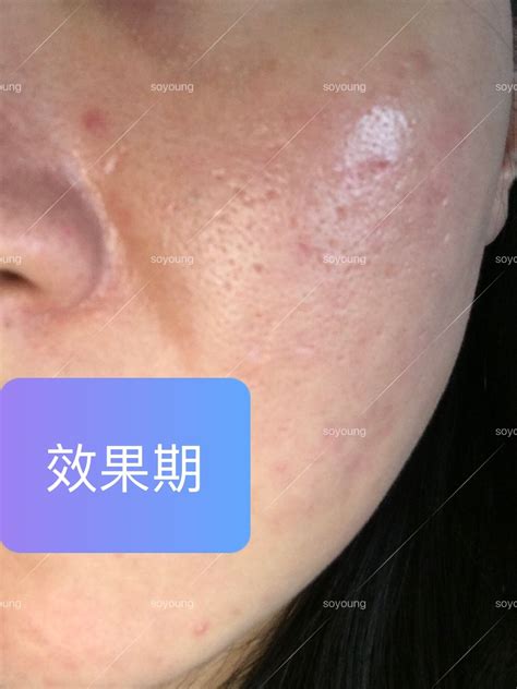 赛洛丝汀5DCC胶原蛋白微针