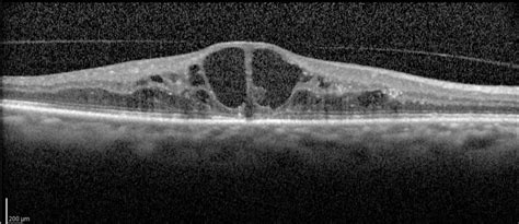Macular Edema Oct