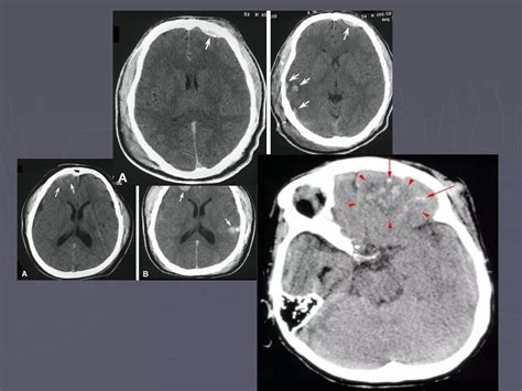 2 Brain Emergency Ppt