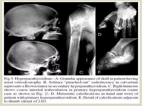 Presentation1 Radiological Imaging Of Hyperparathyroidism Pptx