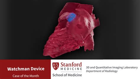 Watchman Device Oct 2024 Case Of The Month