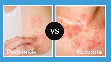 Psoriasis Vs Eczema Key Differences Symptoms And Treatments Explain