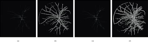 Analysis Of Frangi Filtering Enhancement Using Drive Dataset A Thin