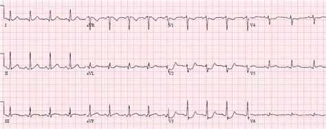 Posterior Mi Ecg Cases 6 Emergency Medicine Cases