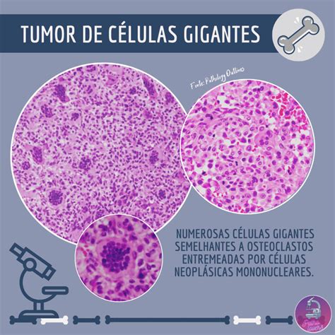Patologia Óssea Tumor De Células Gigantes Patholovers