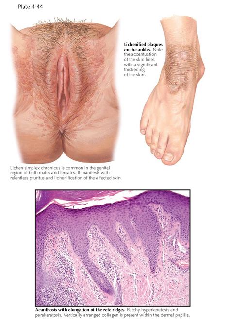 Lichen Simplex Chronicus Pediagenosis