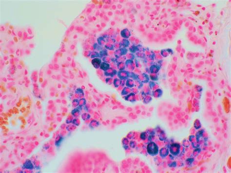 Pathology Outlines Respiratory Bronchiolitis