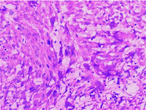 Representative Image Of Tumoral Mass Arising From The Wall Of Jejunum