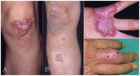 302 Atypical Mycobacteria Flashcards Quizlet 302 Atypical Mycobacteria Flashcards Quizlet
