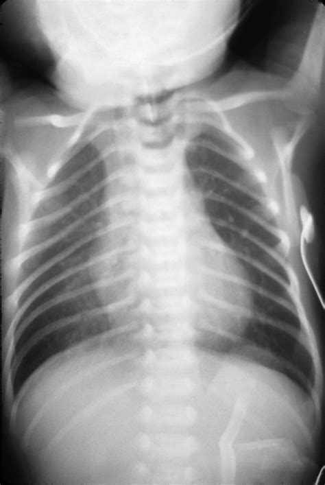 Selected Gastrointestinal Anomalies In The Neonate Clinical Tree