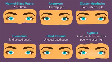 Pupil Size Chart Drugs