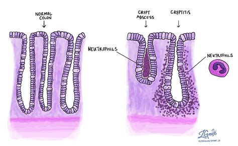 Crypt Abscess Pathology Dictionary Mypathologyreportca