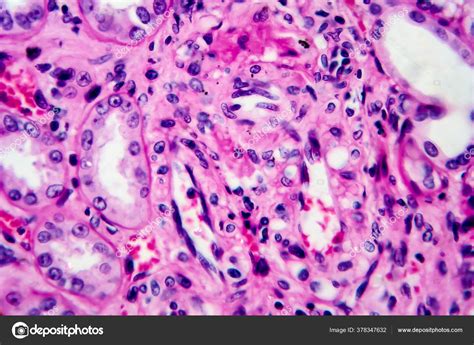 Chronic Pyelonephritis Light Micrograph Photo Microscope High