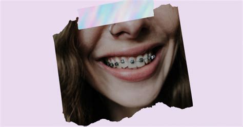 Getting Braces What You Need To Know About Getting Braces