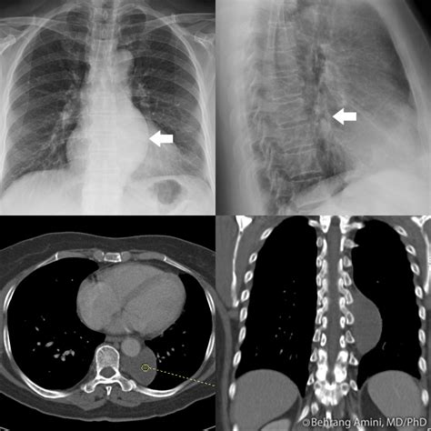 Roentgen Ray Reader Posterior Mediastinal Mass
