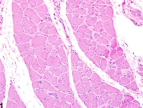 Skeletal Muscle Fibrosis Nonneoplastic Lesion Atlas