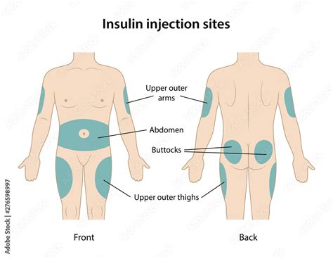 Diabetes Insulin Injection Sites Shown On The Body Upper Outer Arms