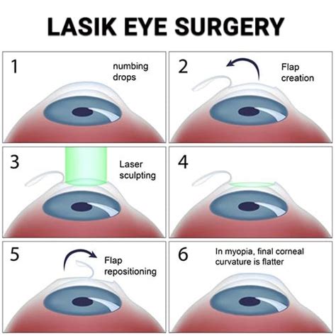 Understanding The Basics Of Lasik Surgery